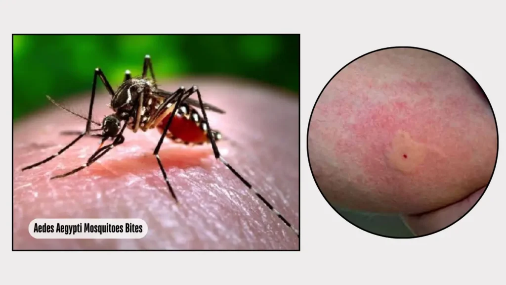 9 Types Of Mosquitoes Bites: Identification with Picture