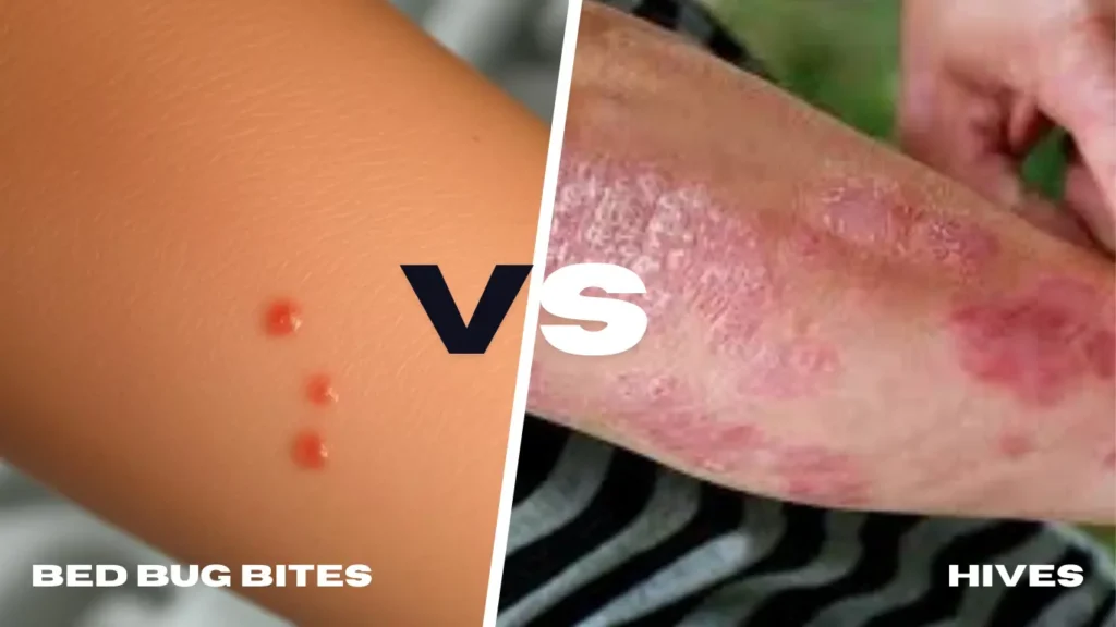 Bed Bug Bites vs Flea, Mosquito, Hives, rash, Scabies bites