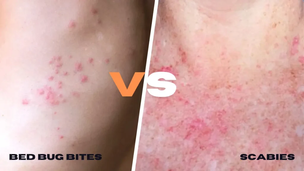 Bed Bug Bites vs Flea, Mosquito, Hives, rash, Scabies bites
