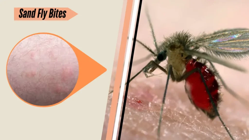 Different Types of Insect Bites: Identification with Picture