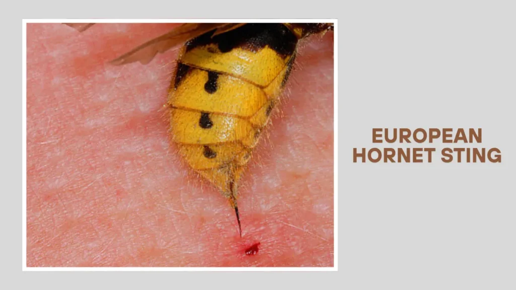 12 Types Of Hornet Stings Reaction Symptoms Treatment 12 Types Of Hornet Stings Reaction Symptoms Treatment