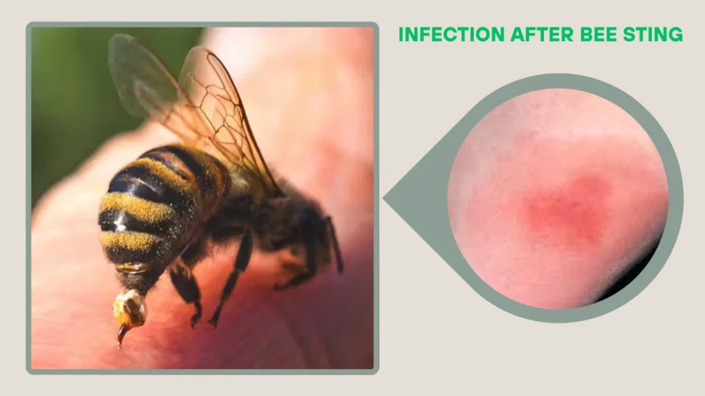 17 Types of Bee Stings: Symptoms, Treatment, Species, Reactions