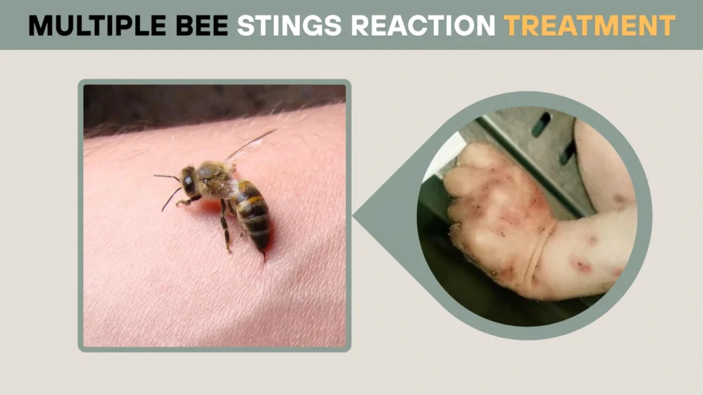 Types of Bee Stings Treatment by Species and Reactions