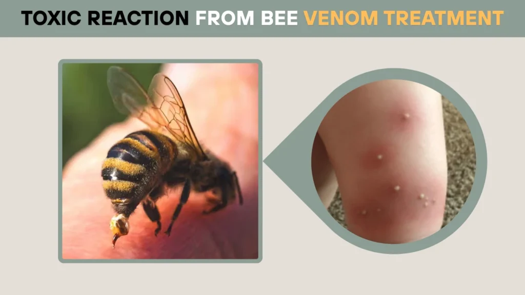 Types of Bee Stings Treatment by Species and Reactions