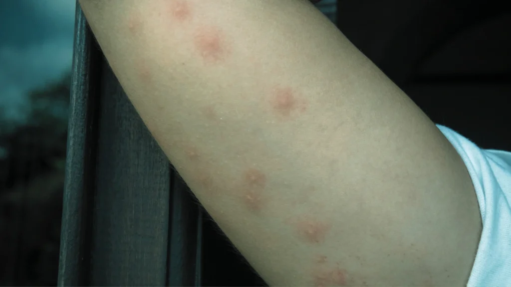 What Do Bed Bug Bites Look Like on Humans? Images