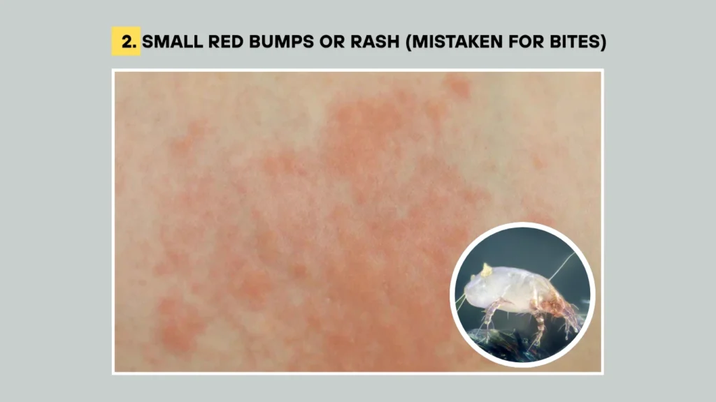 7 Warning Signs of Dust Mites in Your Bed : Bite and Symptom