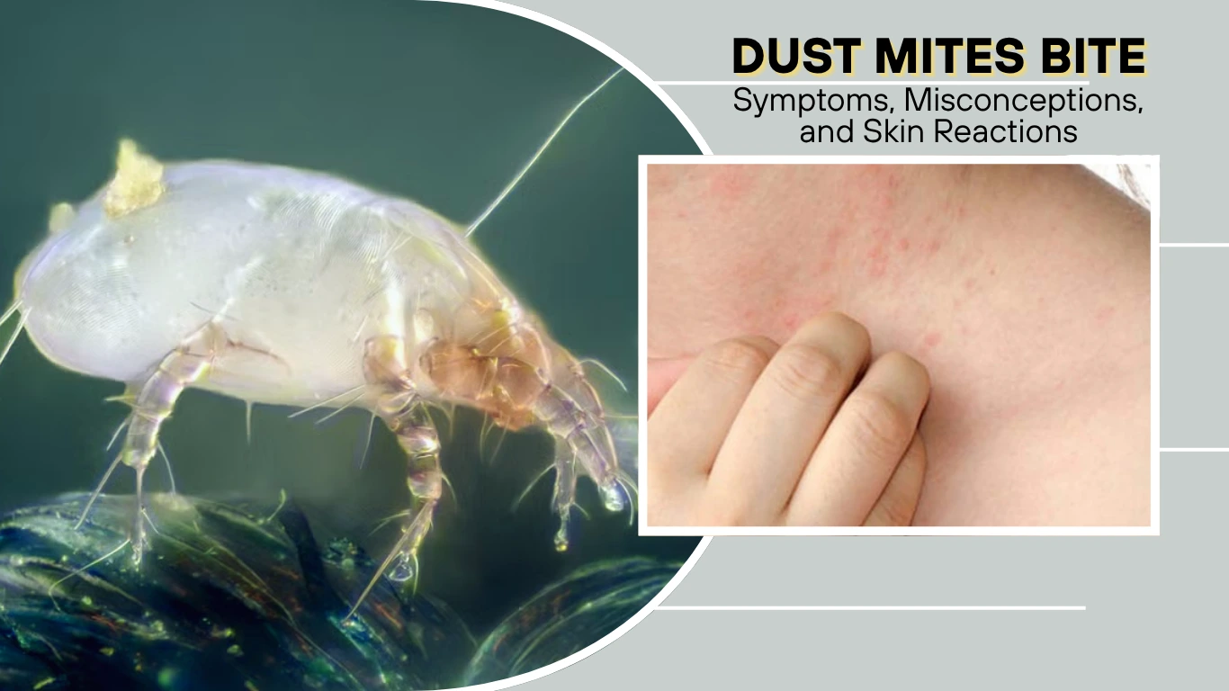 Do Dust Mites Bite? Symptoms, Misconceptions, and Skin Reactions