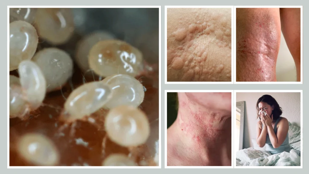 Dust Mite Bites: Symptoms, Identification With Pictures