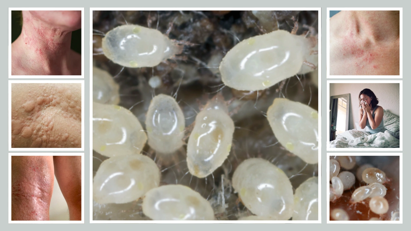 Dust Mite Bites: Symptoms, Identification With Pictures