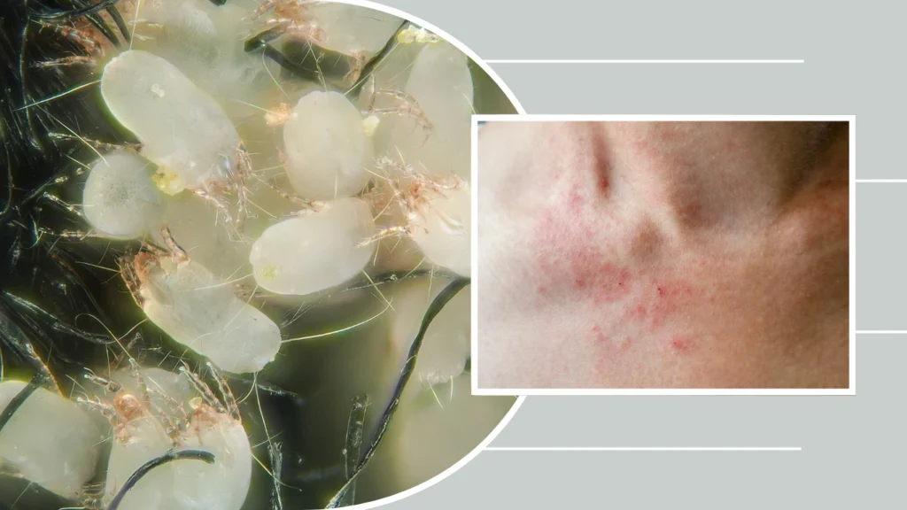 55 FAQs and Facts About Mites: What You Need to Know