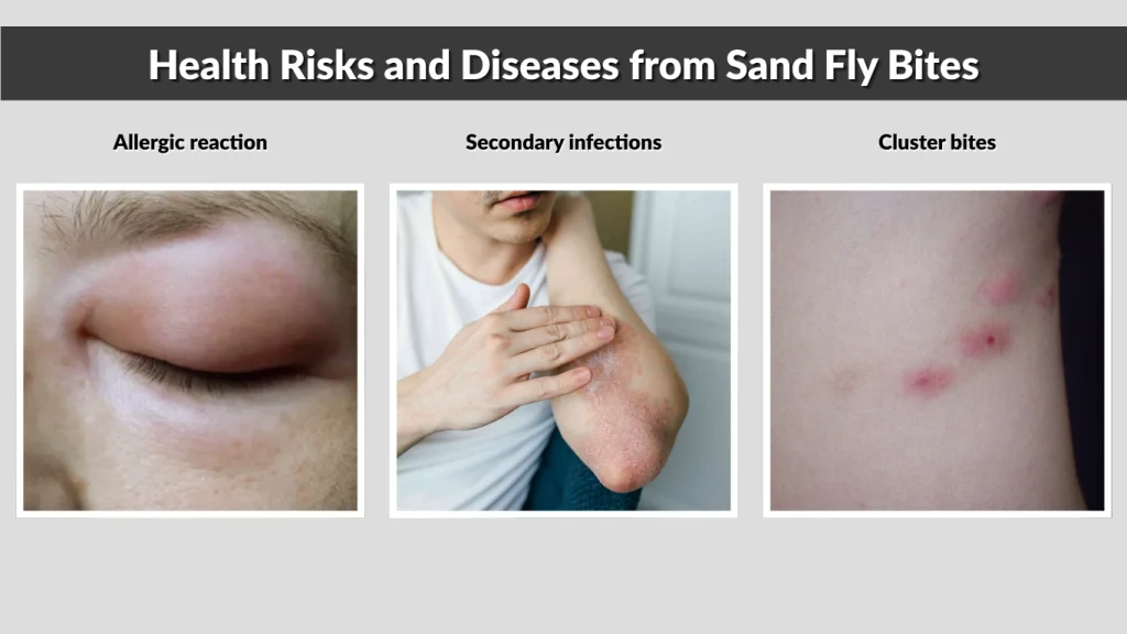Sand Fly Bites on Humans: Symptoms, Pictures & Treatment