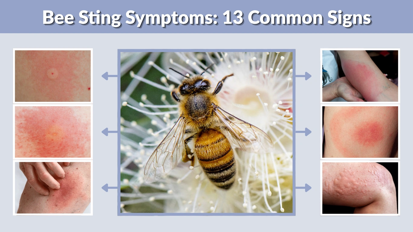 Bee Sting Symptoms: 13 Common Signs and What They Mean