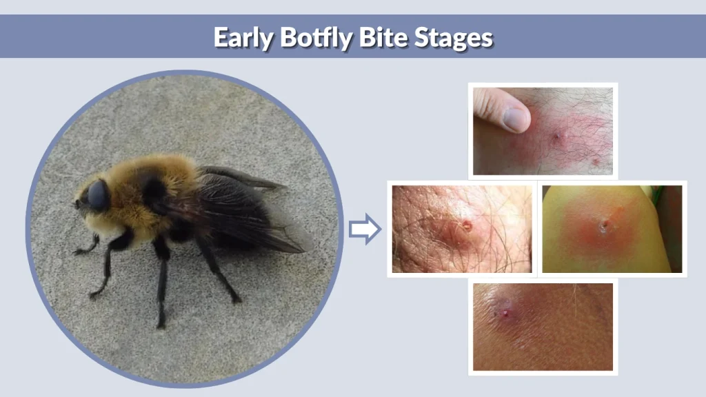 Botfly Bites: Identification, Stages, and Treatment for Humans