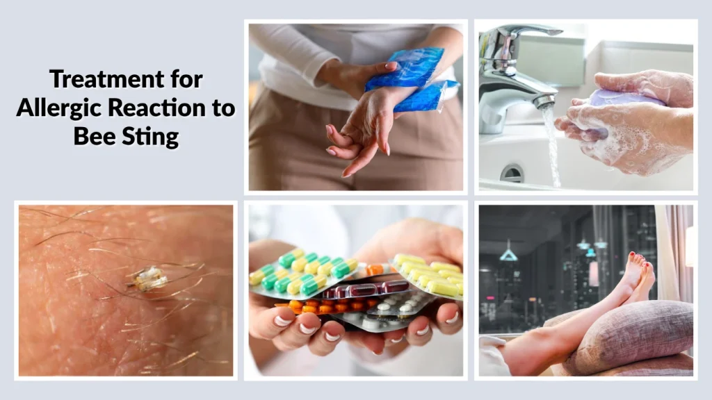 Bee Sting Allergic Reaction: Symptoms, Causes & Treatment Guide