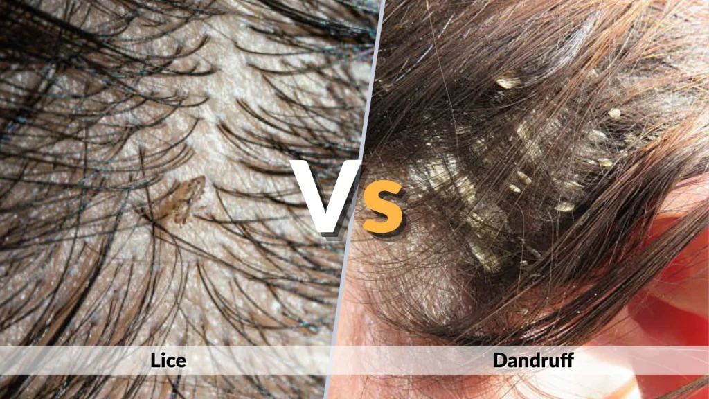 What Does Lice Look Like? Head Lice, Eggs, Bites & Nits
