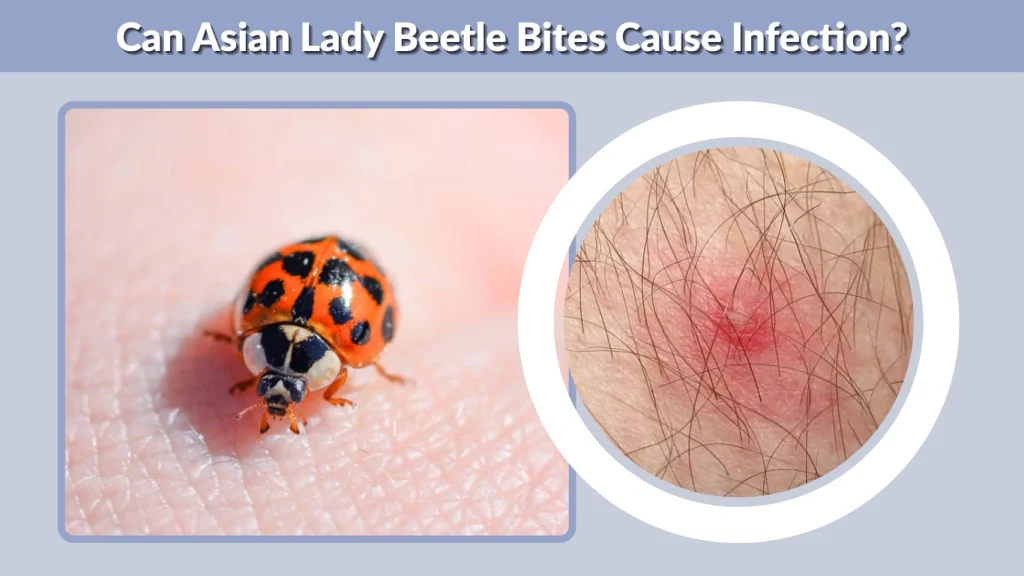 Asian Lady Beetle Bite: Symptoms, Marks & Treatment