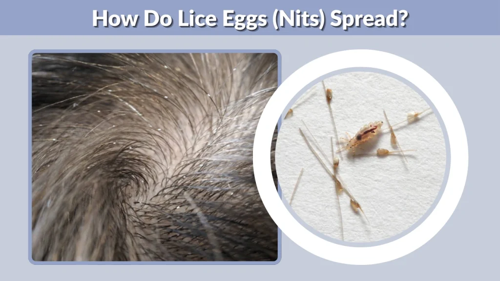 How Do You Get Lice? Causes, Treatment, and Prevention Explained