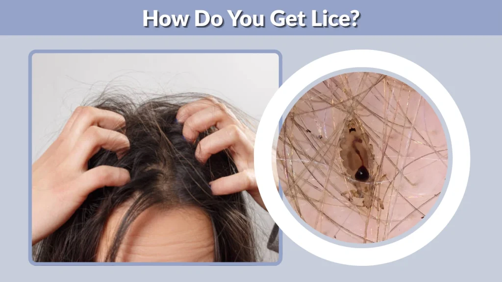 How Do You Get Lice? Causes, Treatment, and Prevention Explained