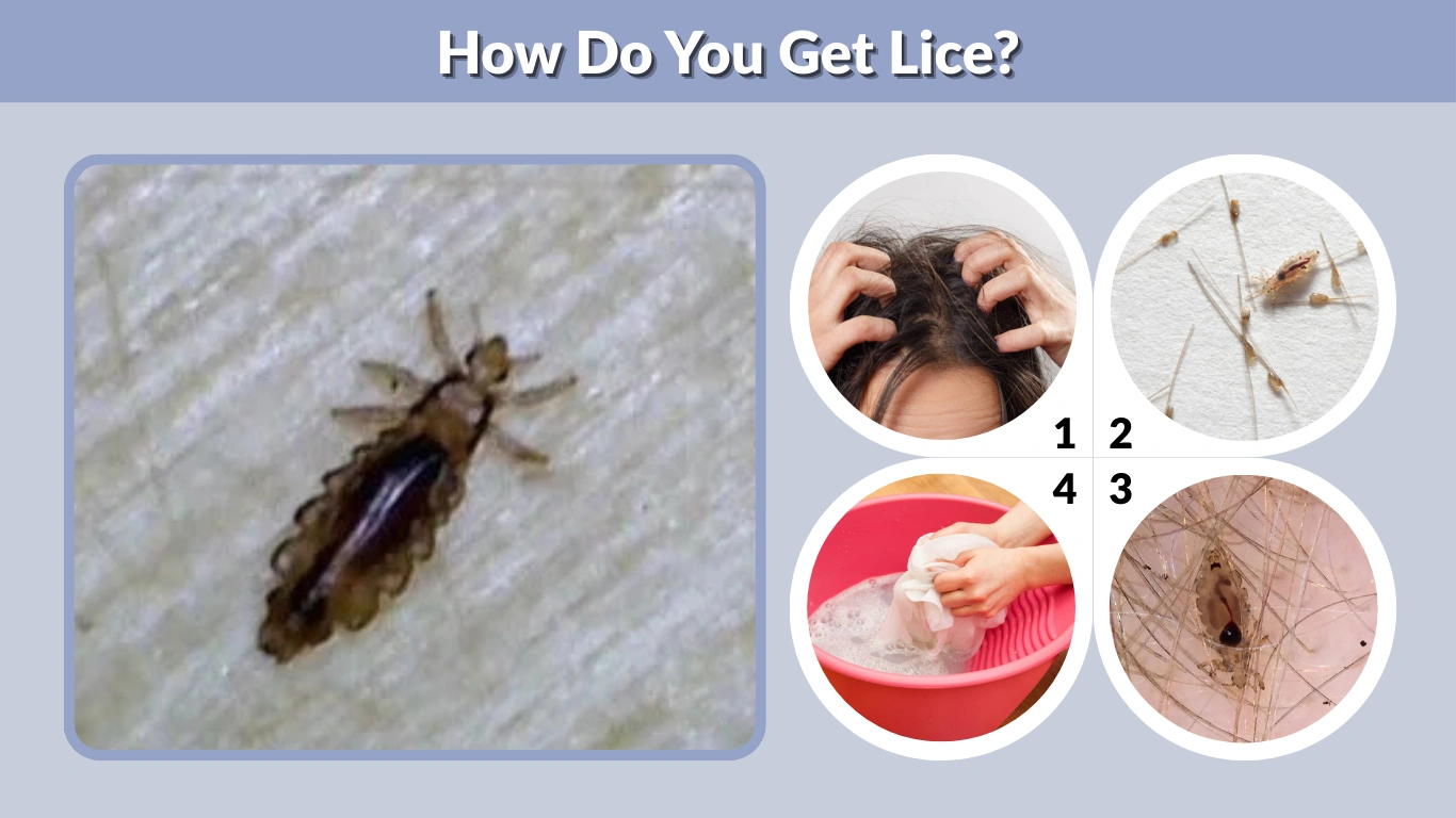 How Do You Get Lice? Causes, Treatment, and Prevention Explained