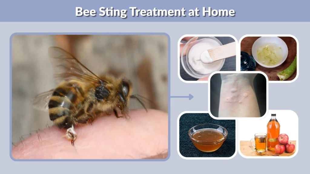 Bee Sting Treatment: Home Remedies, Relief & Care Guide