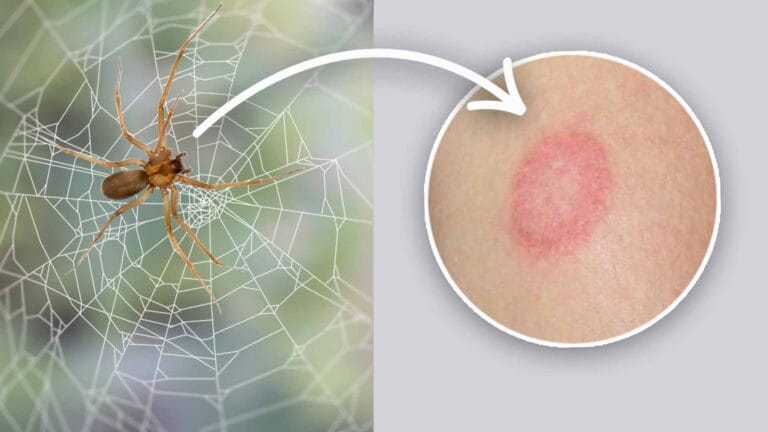 15 Types Of Spider Bites: Identification Chart with Picture