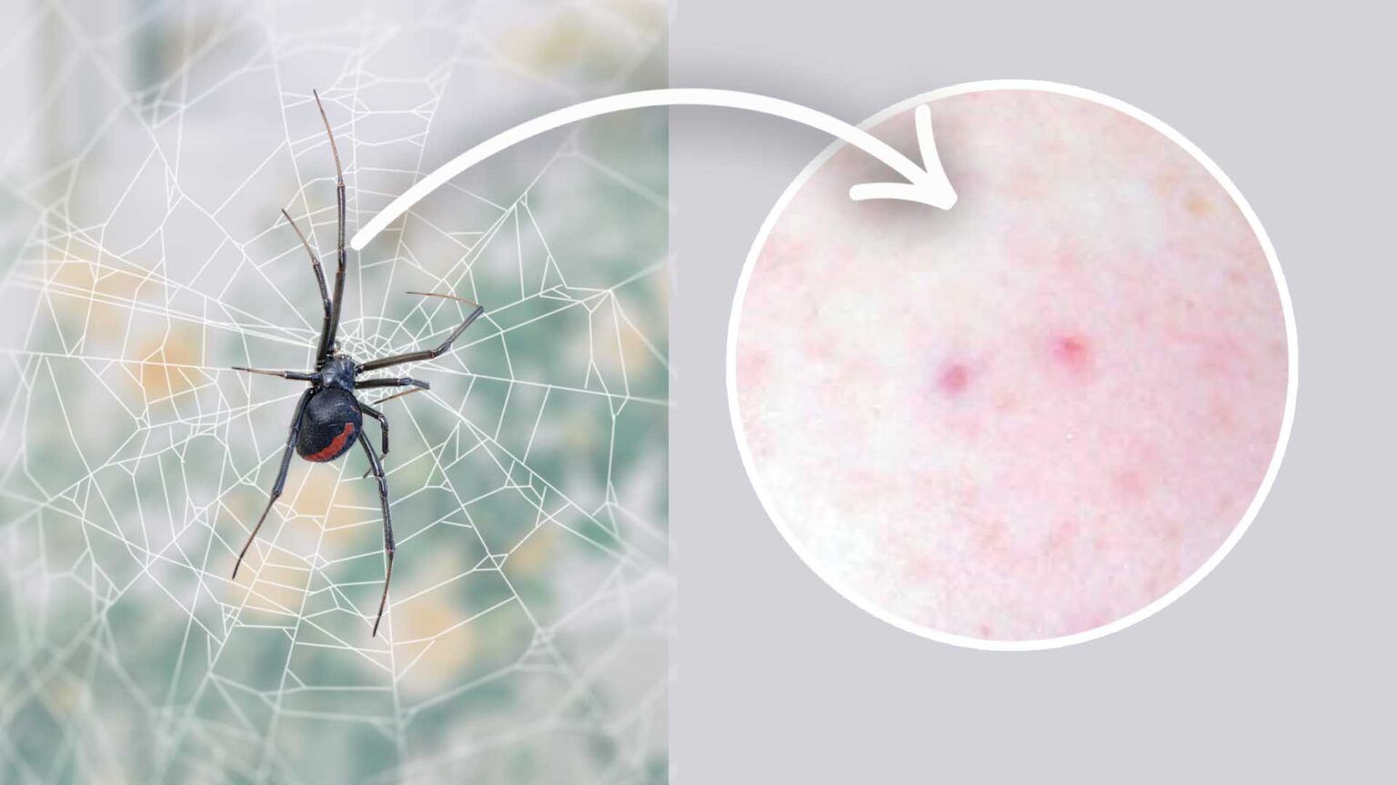 15 Types Of Spider Bites: Identification Chart with Picture