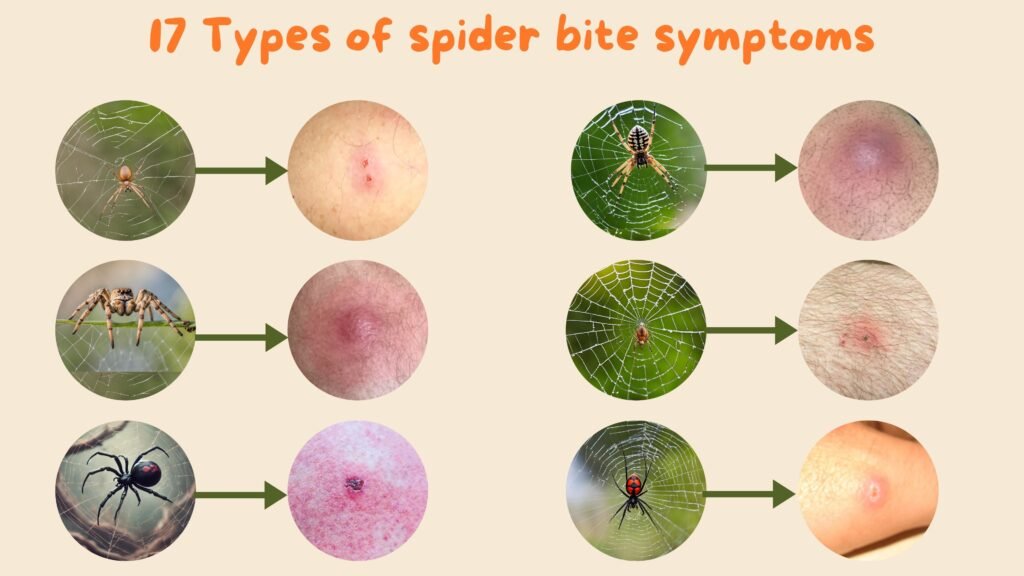 What Can I Do At Home For A Spider Bite Simply Do It What Can I Do At Home For A Spider Bite Simply Do It