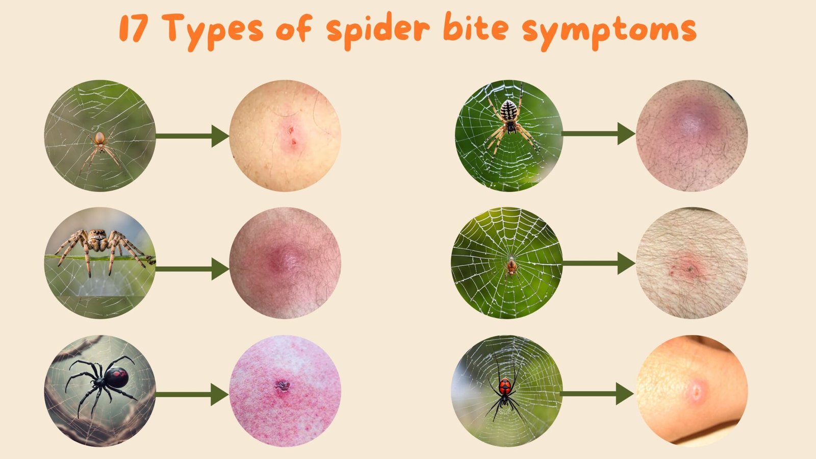 17 Types Of Spider Bite Symptoms ID With Pictures 
