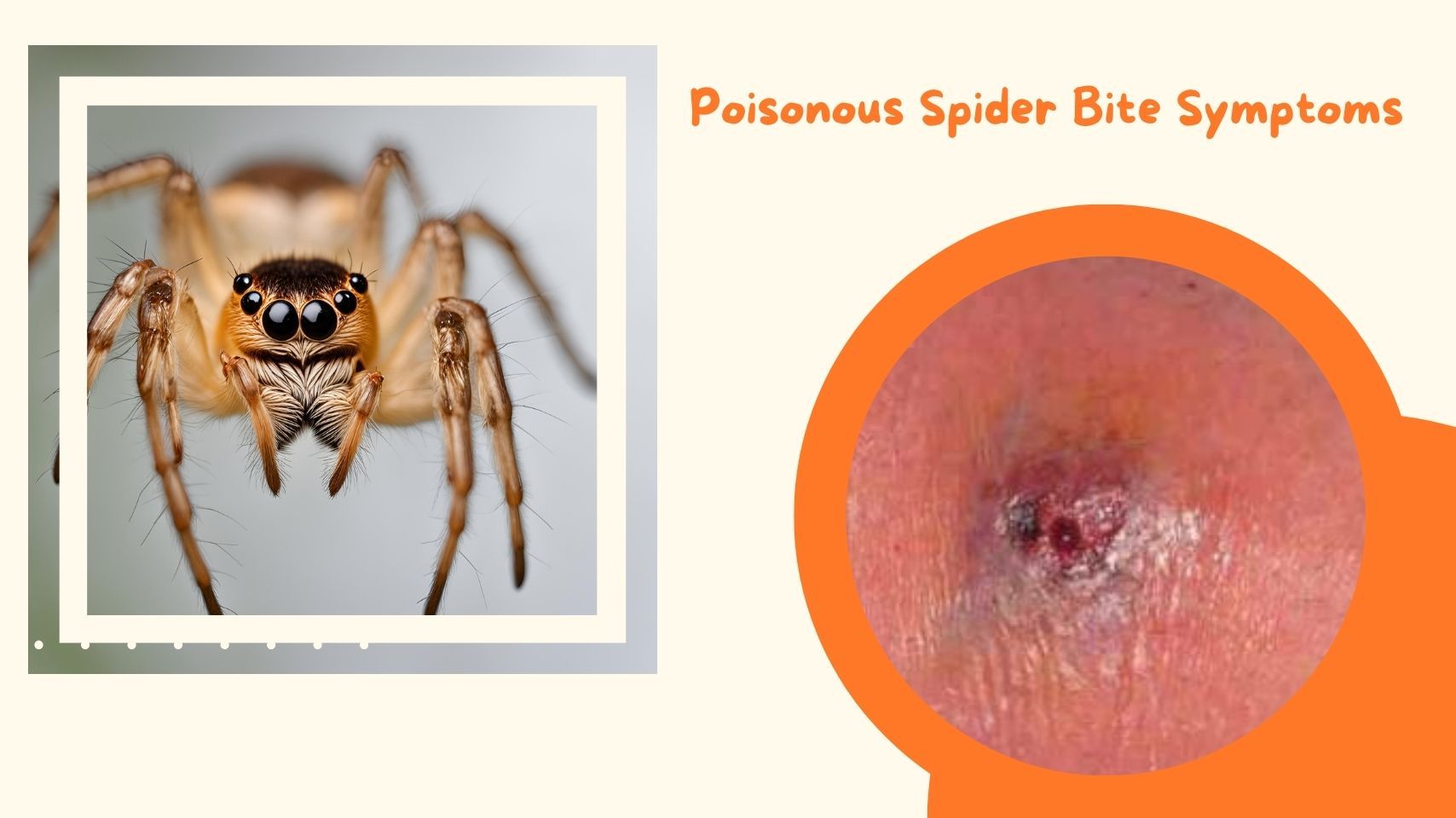17 Types of spider bite symptoms (ID with pictures)