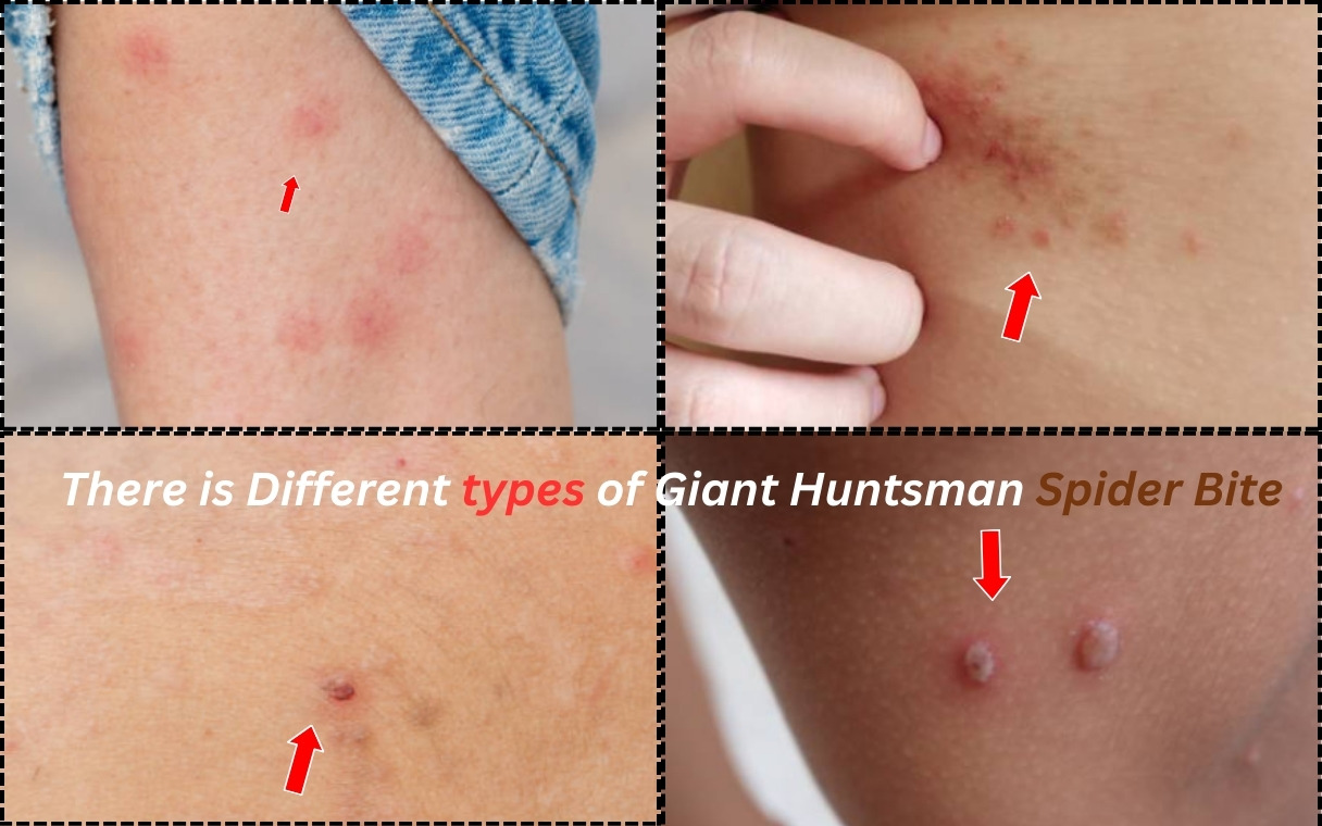 Giant Huntsman Spider Bite: Symptoms, Facts, and What You Need to Know