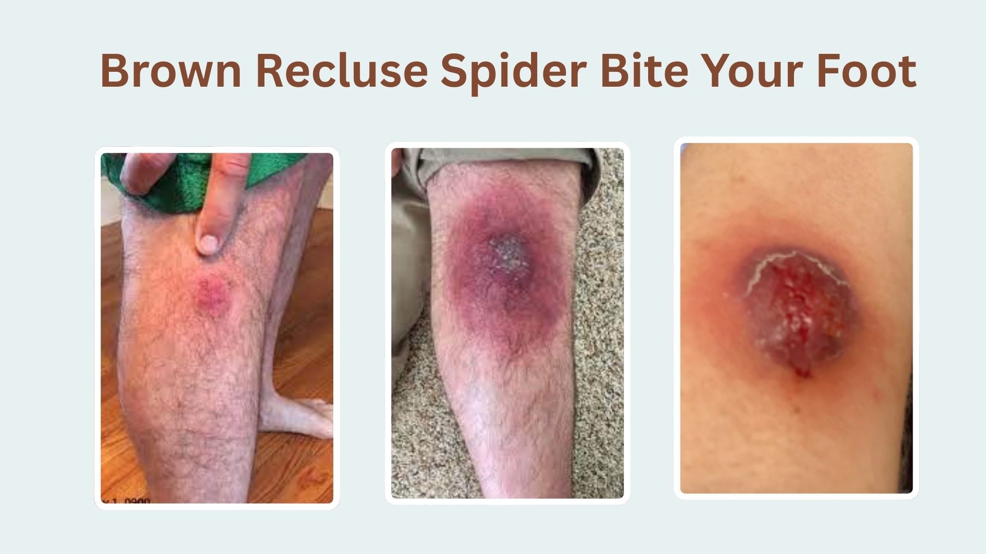 Brown Recluse Spider Bite: Identification with Pictures